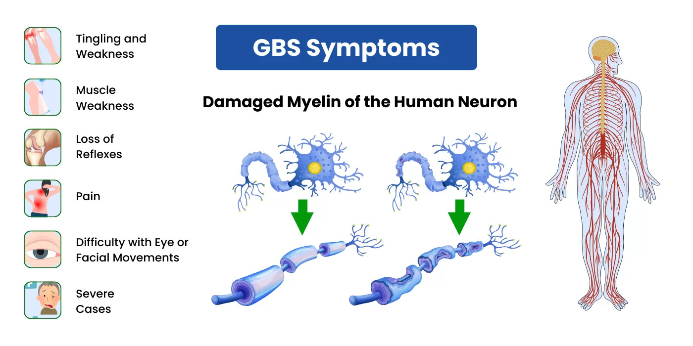 Guillain Barre Syndrome Symptoms Guillain Barre Syndrome Symptoms