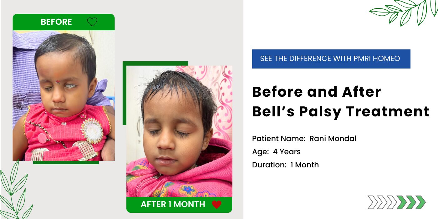 Bell's Palsy: Symptoms, Causes and Self-care Measures - PMRI Homoeo Hall