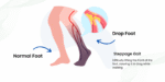 Foot Drop: Causes, Symptoms and Treatment - PMRI Homoeo Hall